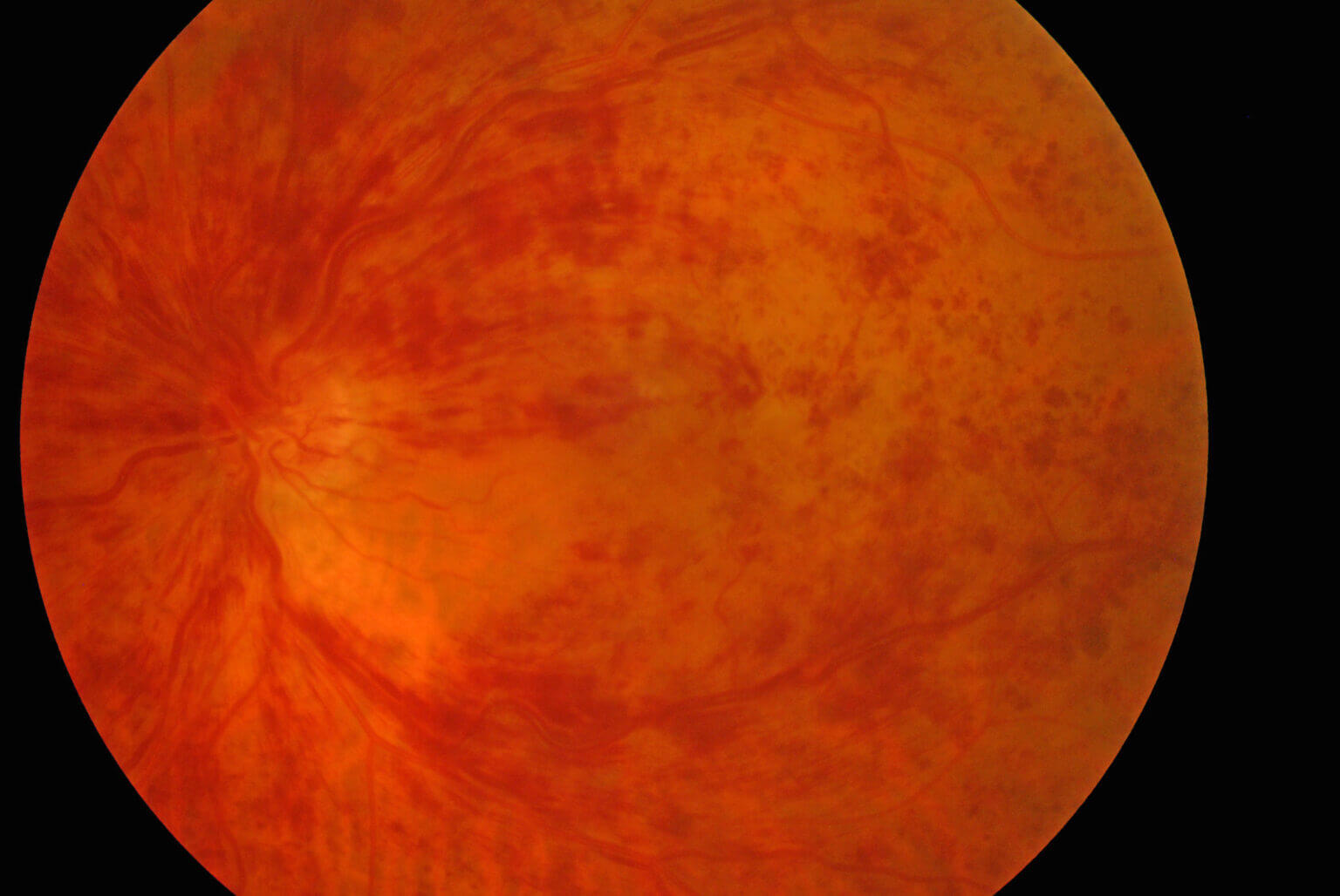 Central Retinal Vein Occlusions - Retina Consultants Of Michigan