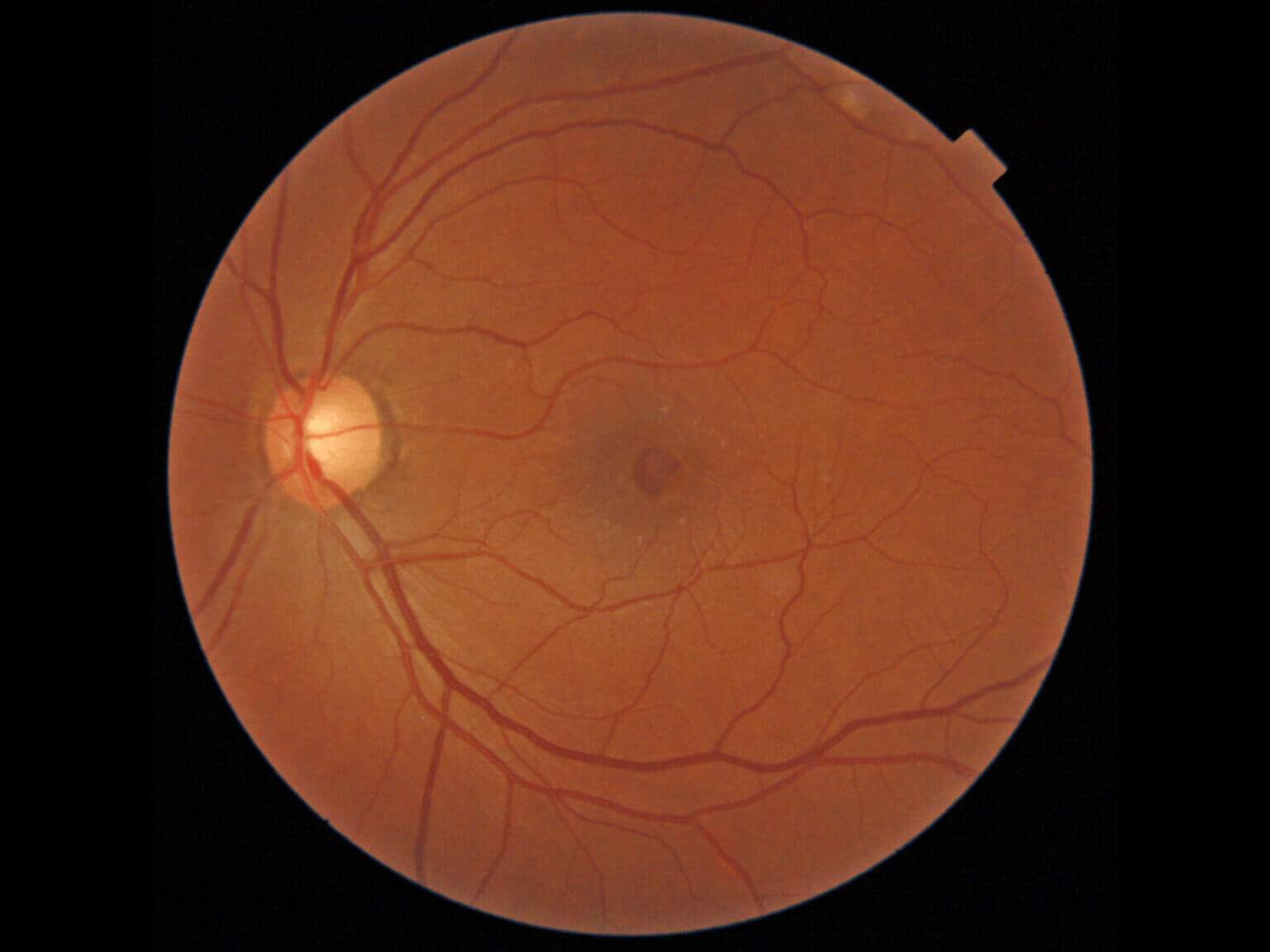 Epiretinal Membrane - Retina Consultants Of Michigan