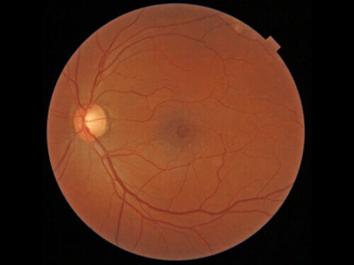 Epiretinal Membrane - Retina Consultants Of Michigan